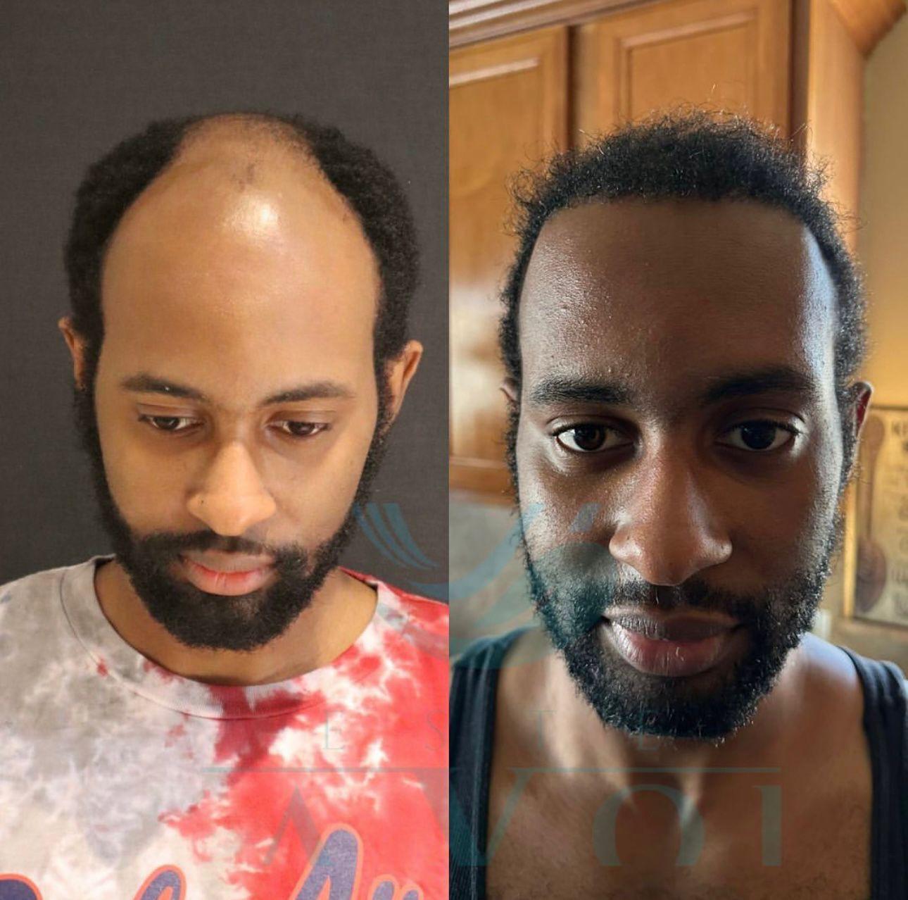 Coûts de Greffe de Cheveux Afro à Istanbul 2025 – Meilleures Cliniques ...